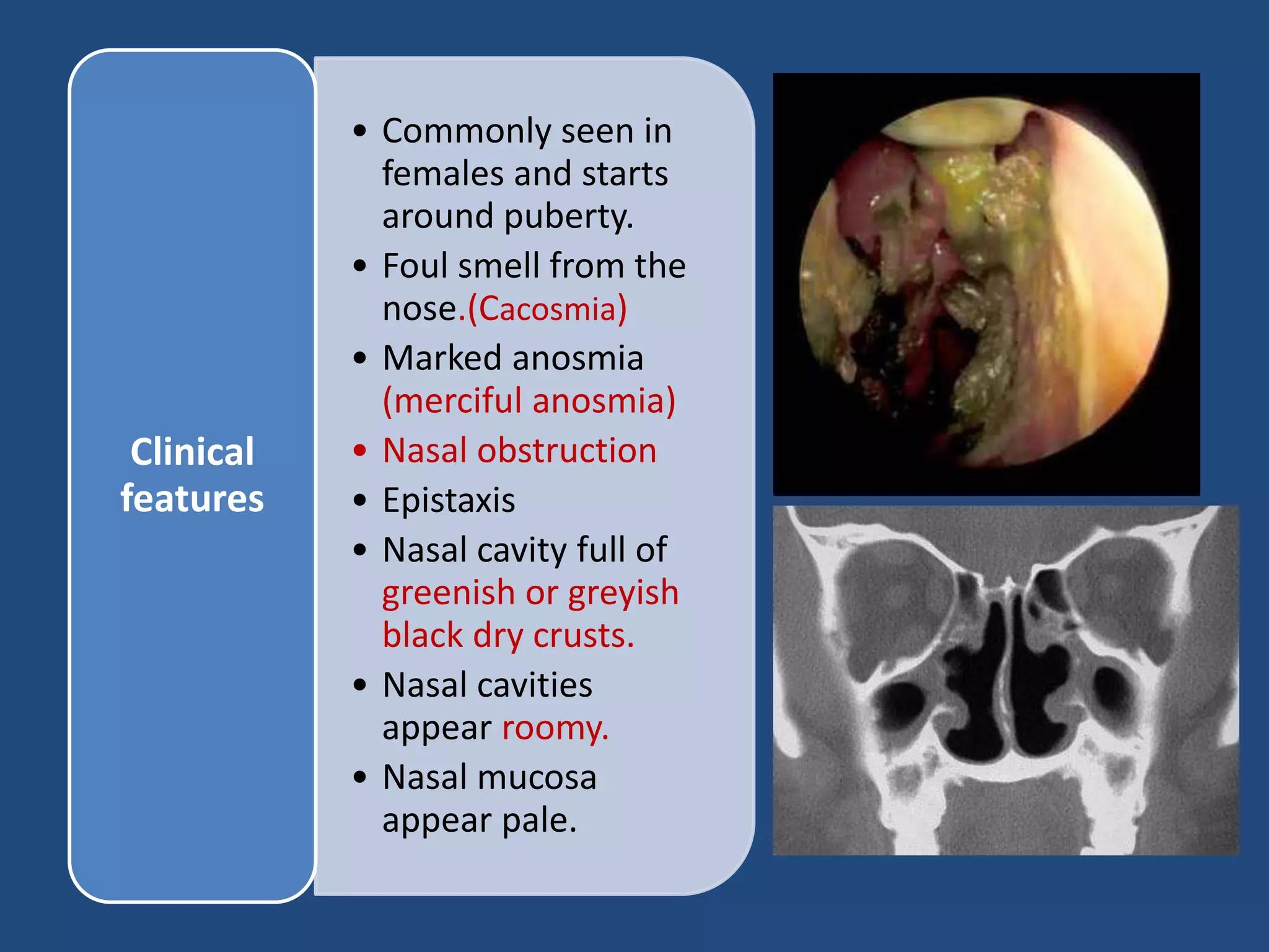 Acute and chronic rhinitis.pptx