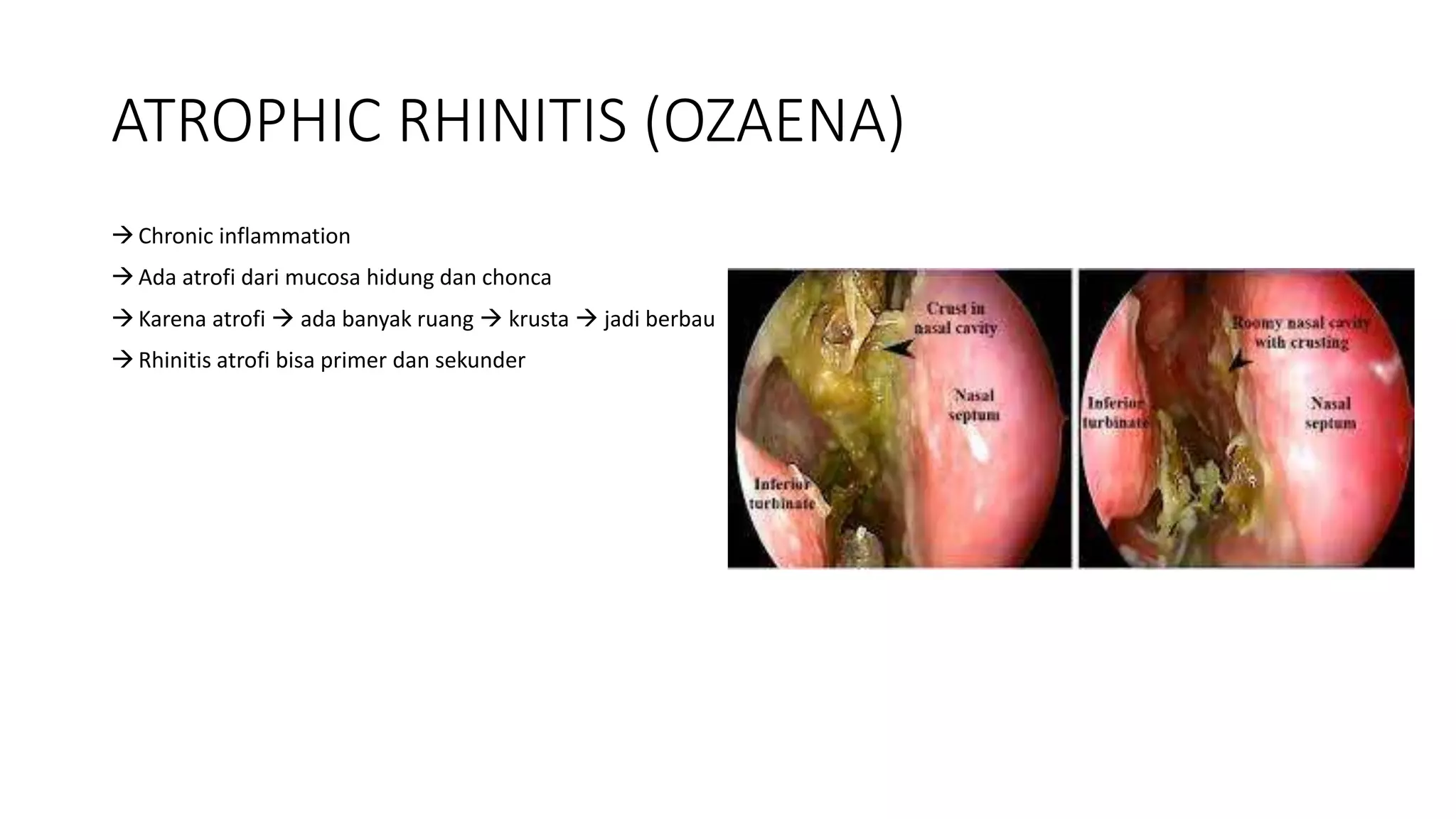 Acute and chronic rhinitis.pptx