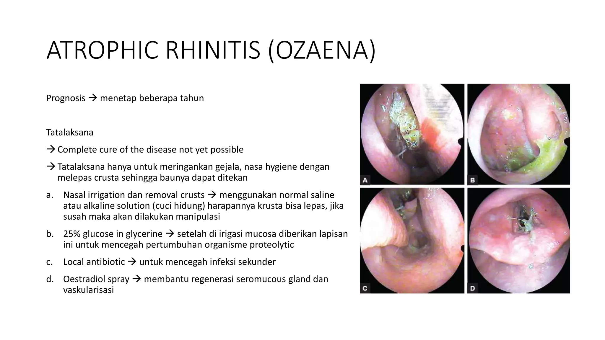 Acute and chronic rhinitis.pptx