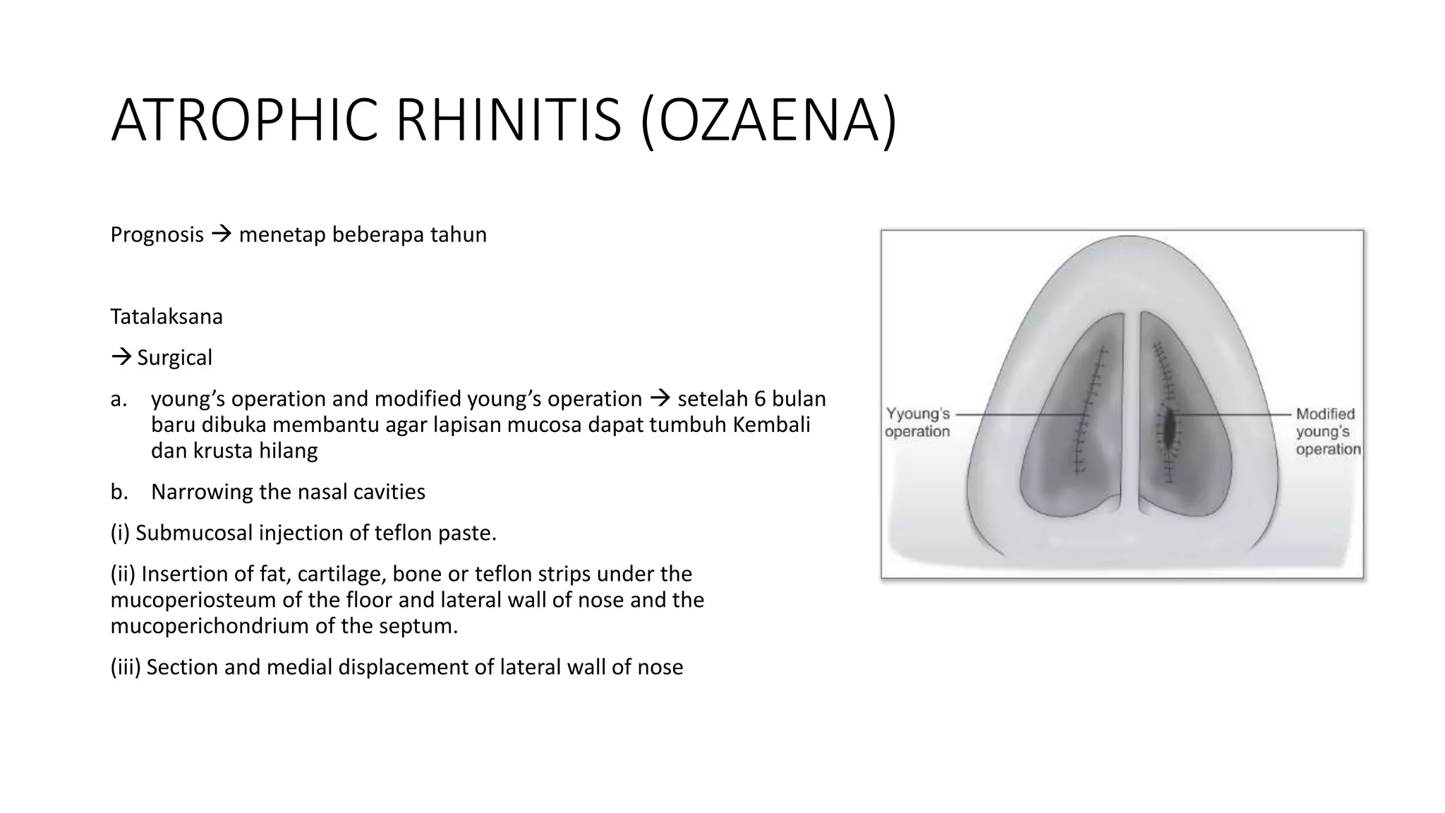 Acute and chronic rhinitis.pptx
