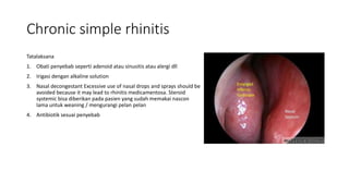 Acute and chronic rhinitis.pptx