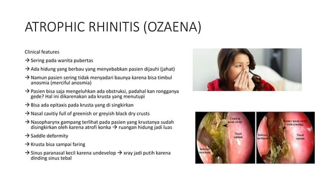 Acute and chronic rhinitis.pptx