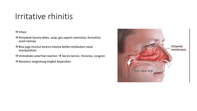Acute and chronic rhinitis.pptx