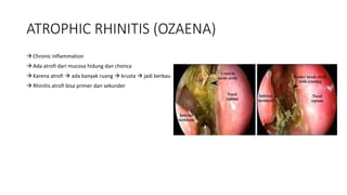 Acute and chronic rhinitis.pptx