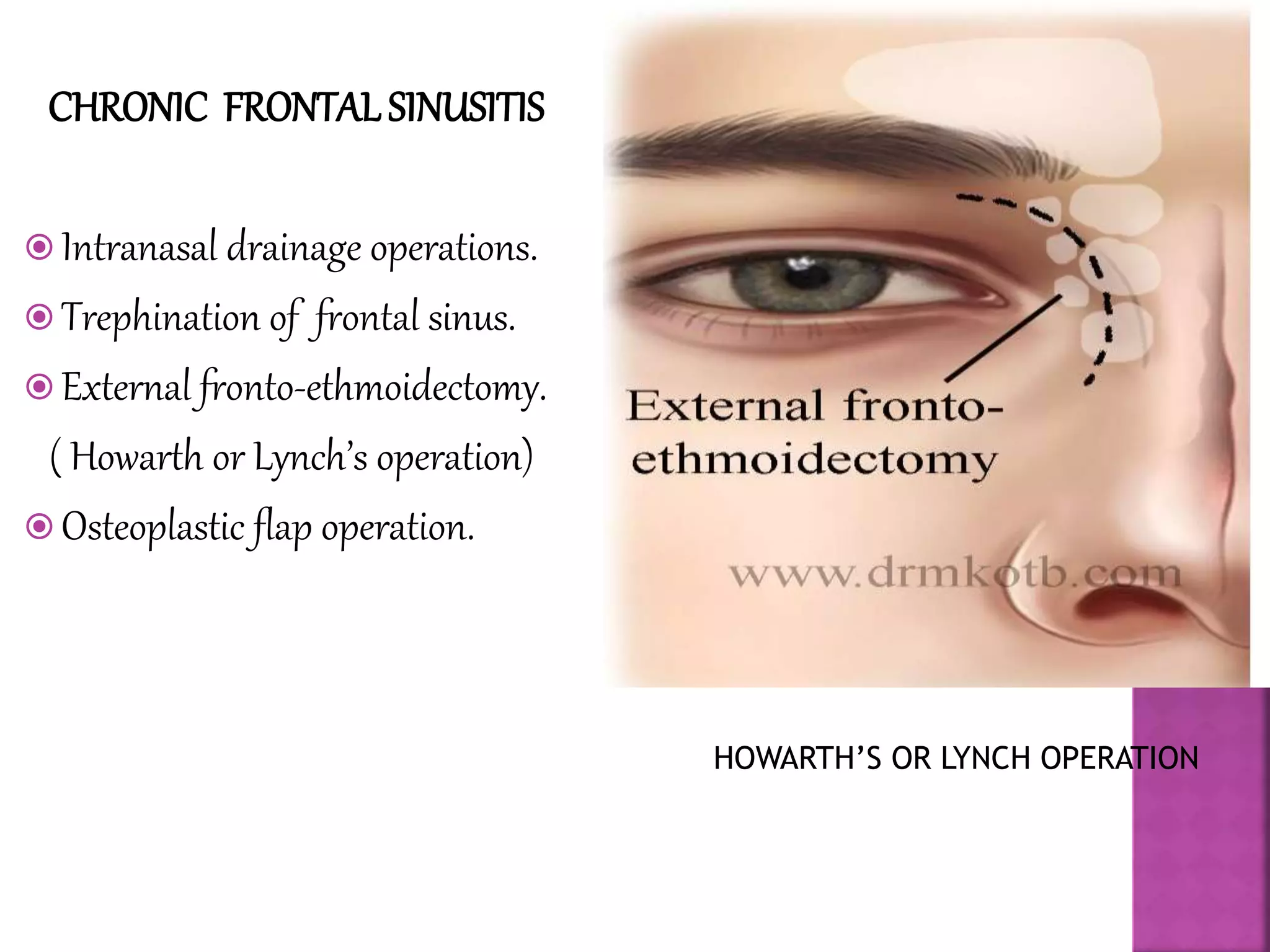 Acute and chronic sinusitis | PPTX