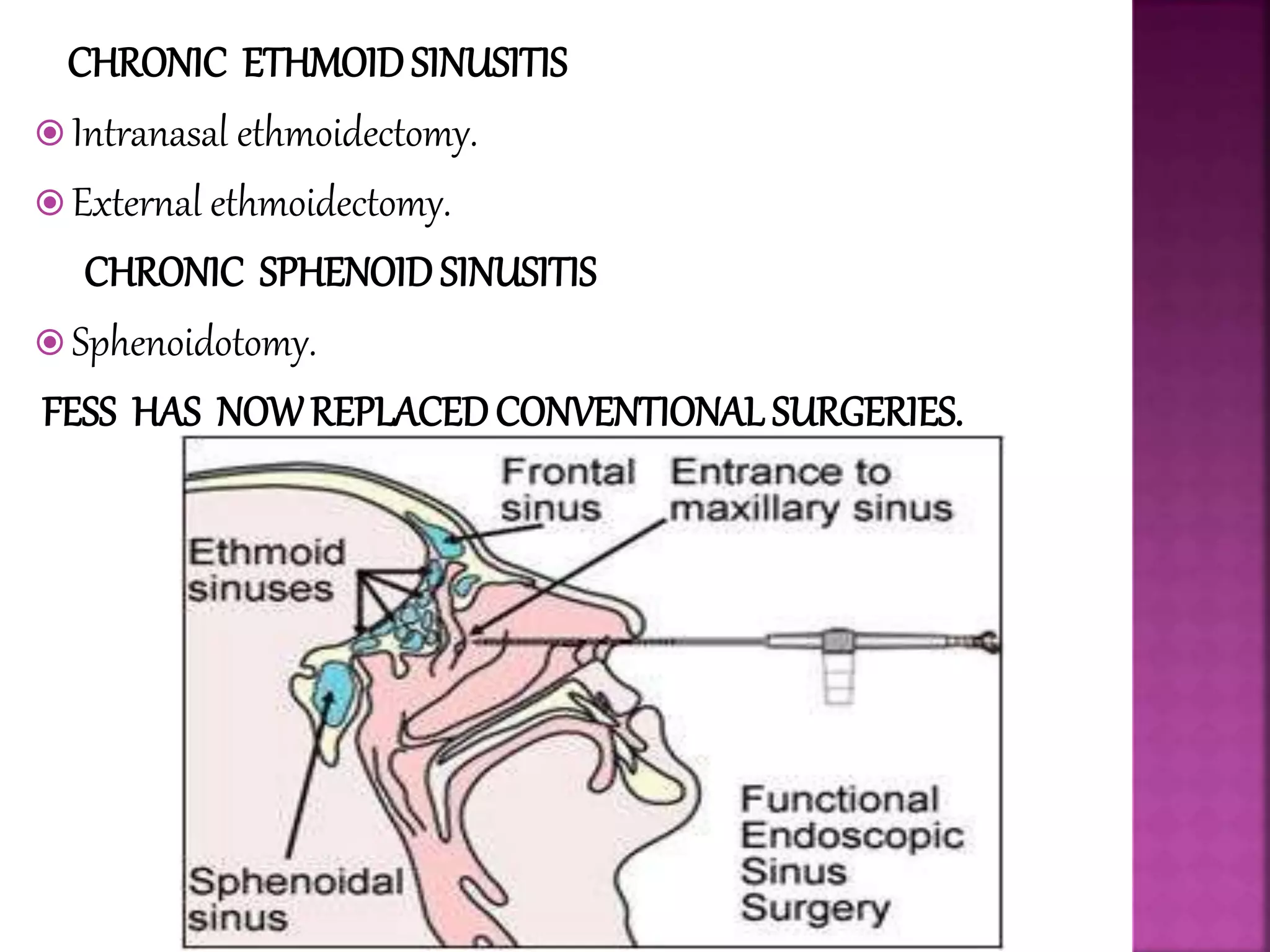 Acute and chronic sinusitis | PPTX