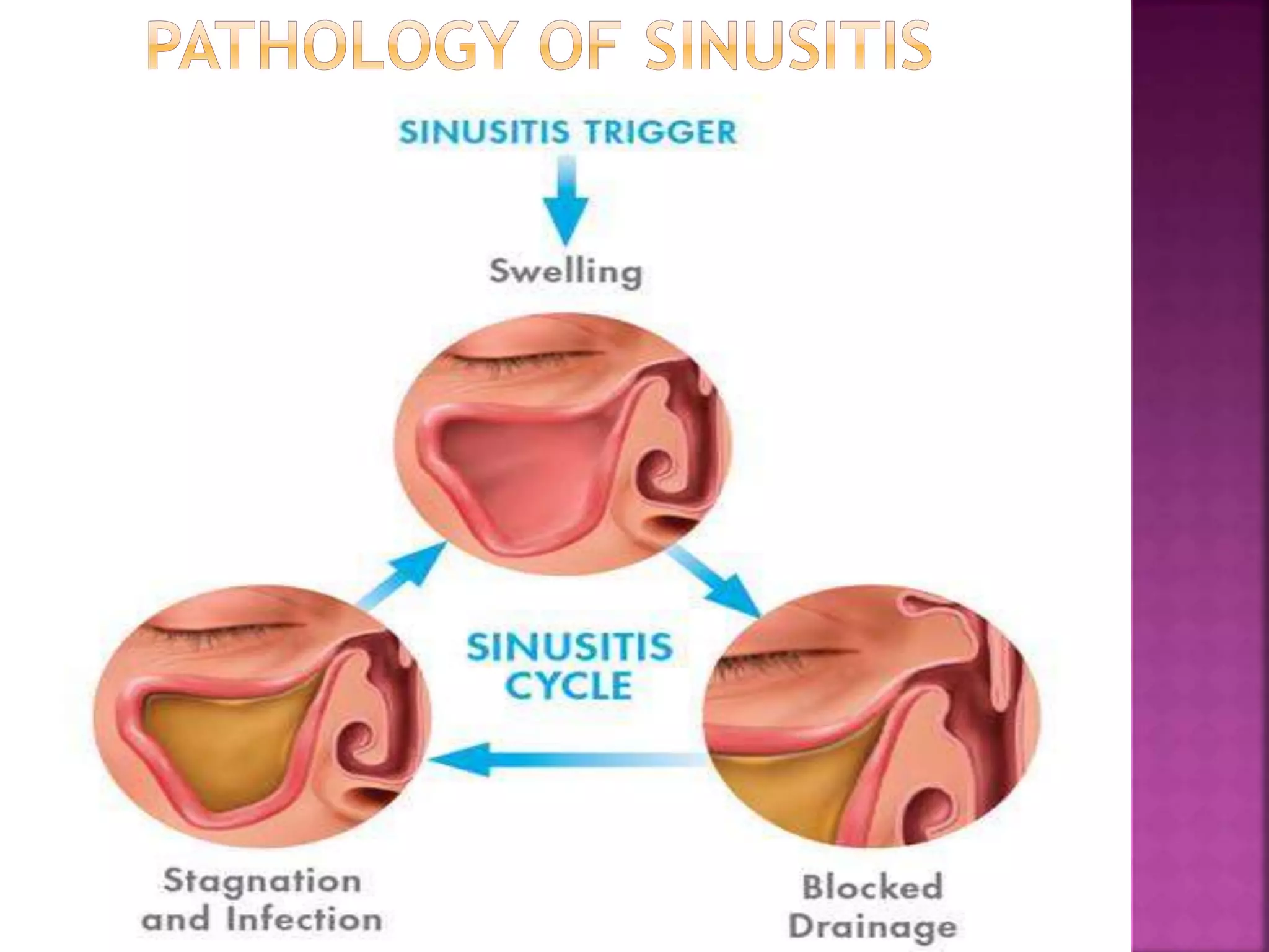 Acute and chronic sinusitis | PPTX
