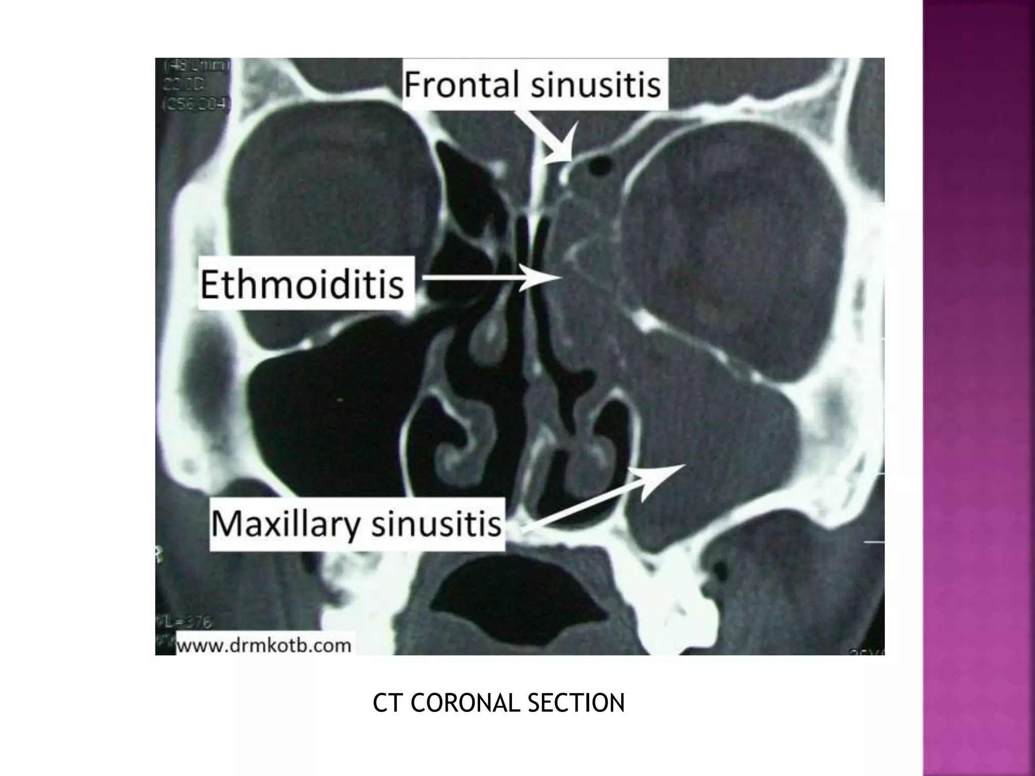 Acute and chronic sinusitis | PPTX