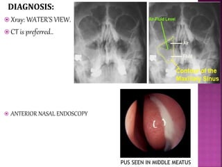 Acute Sinusitis X Ray