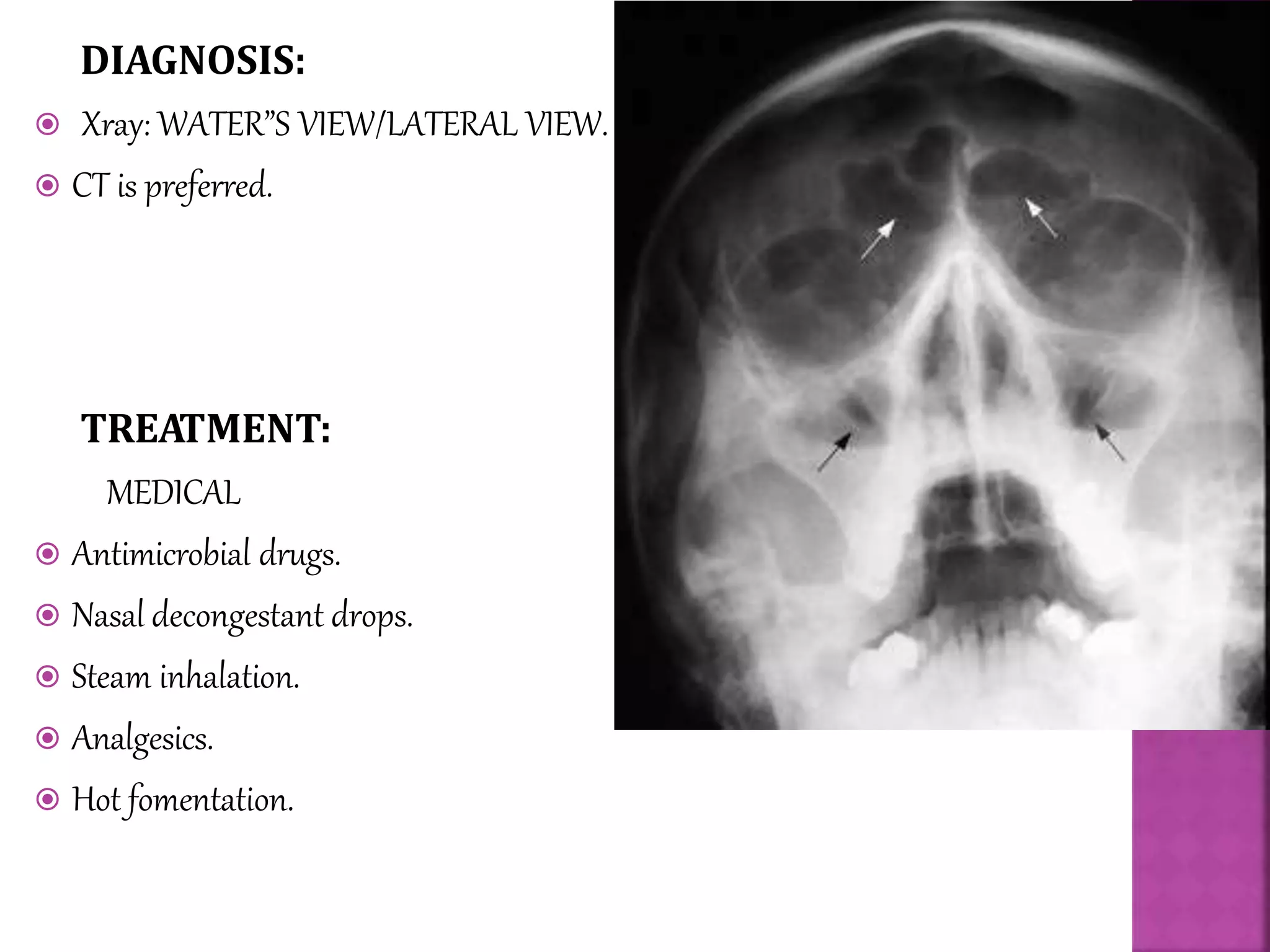 Acute and Chronic Sinusitis.pptx