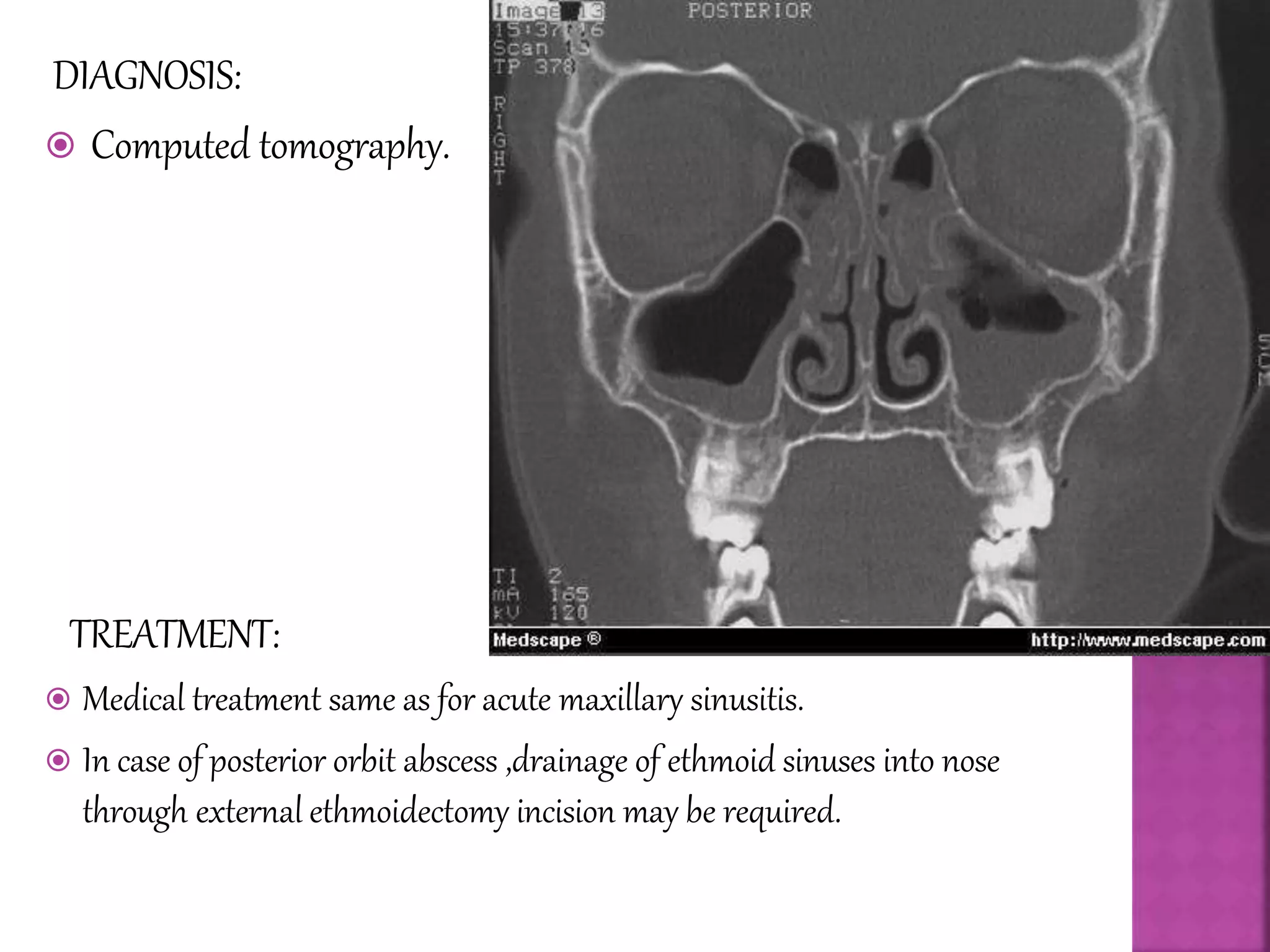 Acute and Chronic Sinusitis.pptx