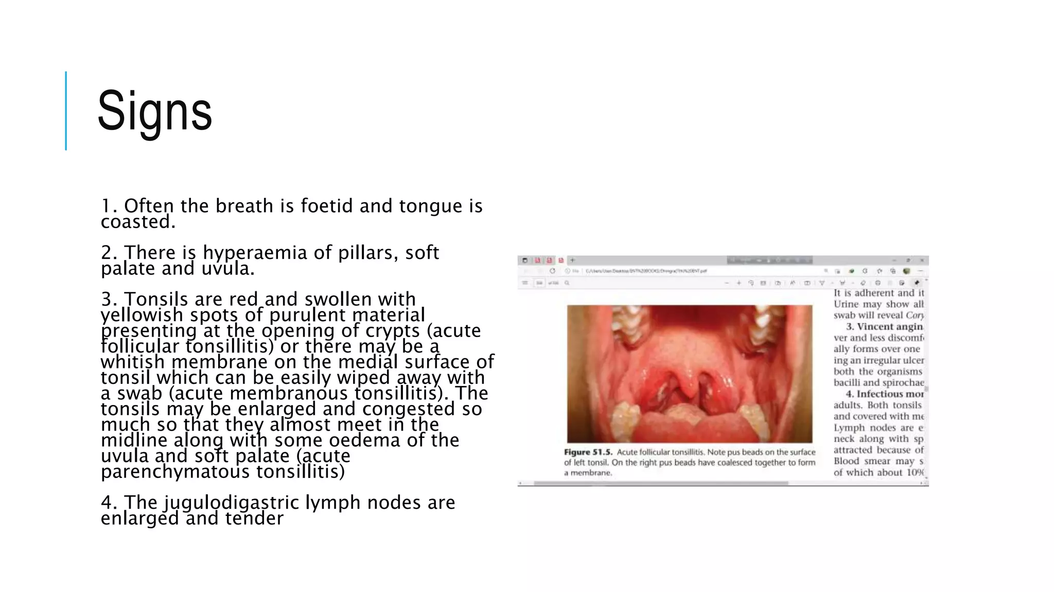 Acute and chronic tonsilitis | PPTX
