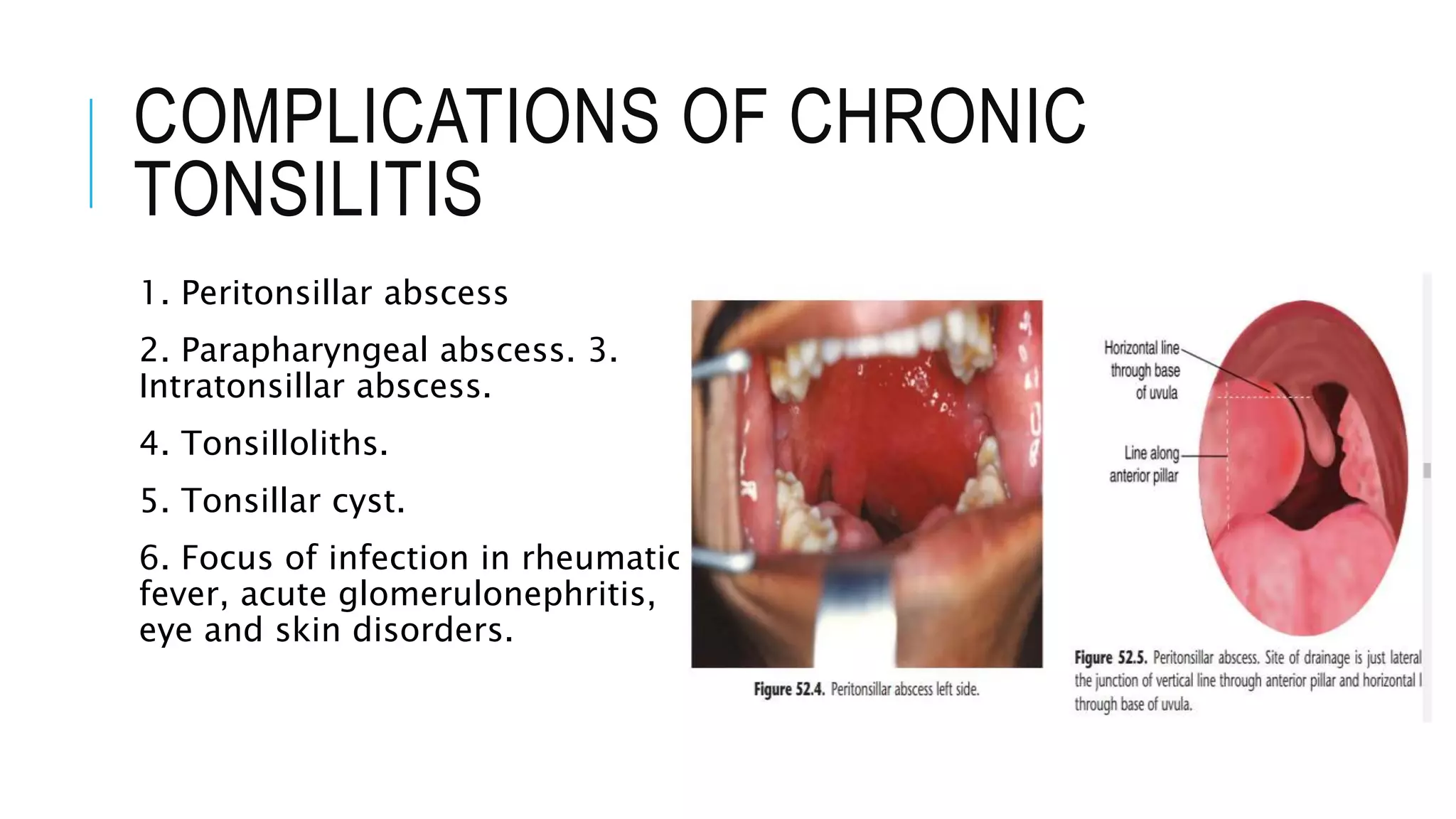 Acute and chronic tonsilitis | PPTX