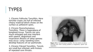 Acute and chronic tonsilitis | PPTX
