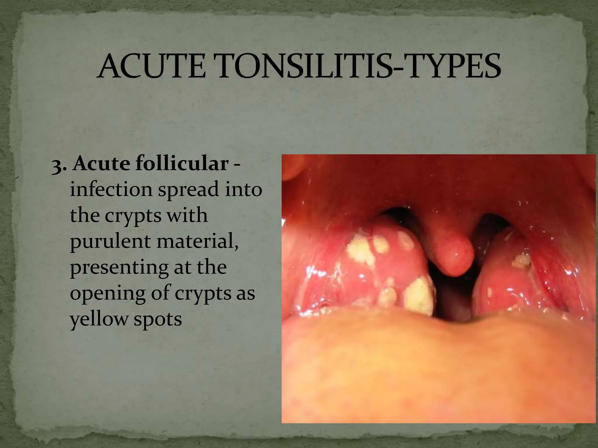 ACUTE AND CHRONIC TONSILITIS.pptx