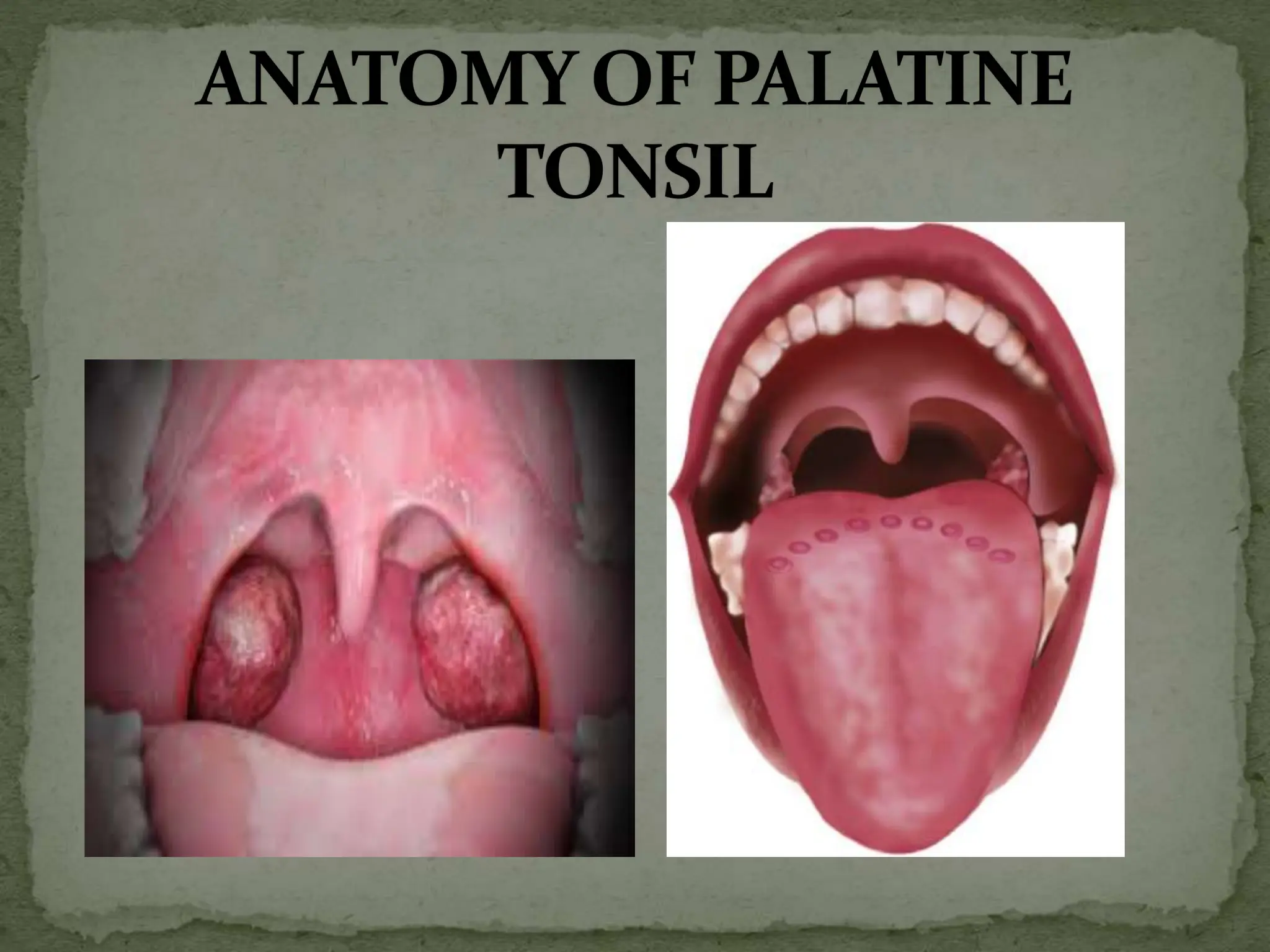 ACUTE AND CHRONIC TONSILITIS.pptx