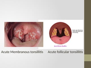 ACUTE AND CHRONIC TONSILLITIS 1.pptx seminar | PPTX