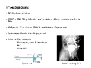 Acute and Chronic Urinary Retention.pptx