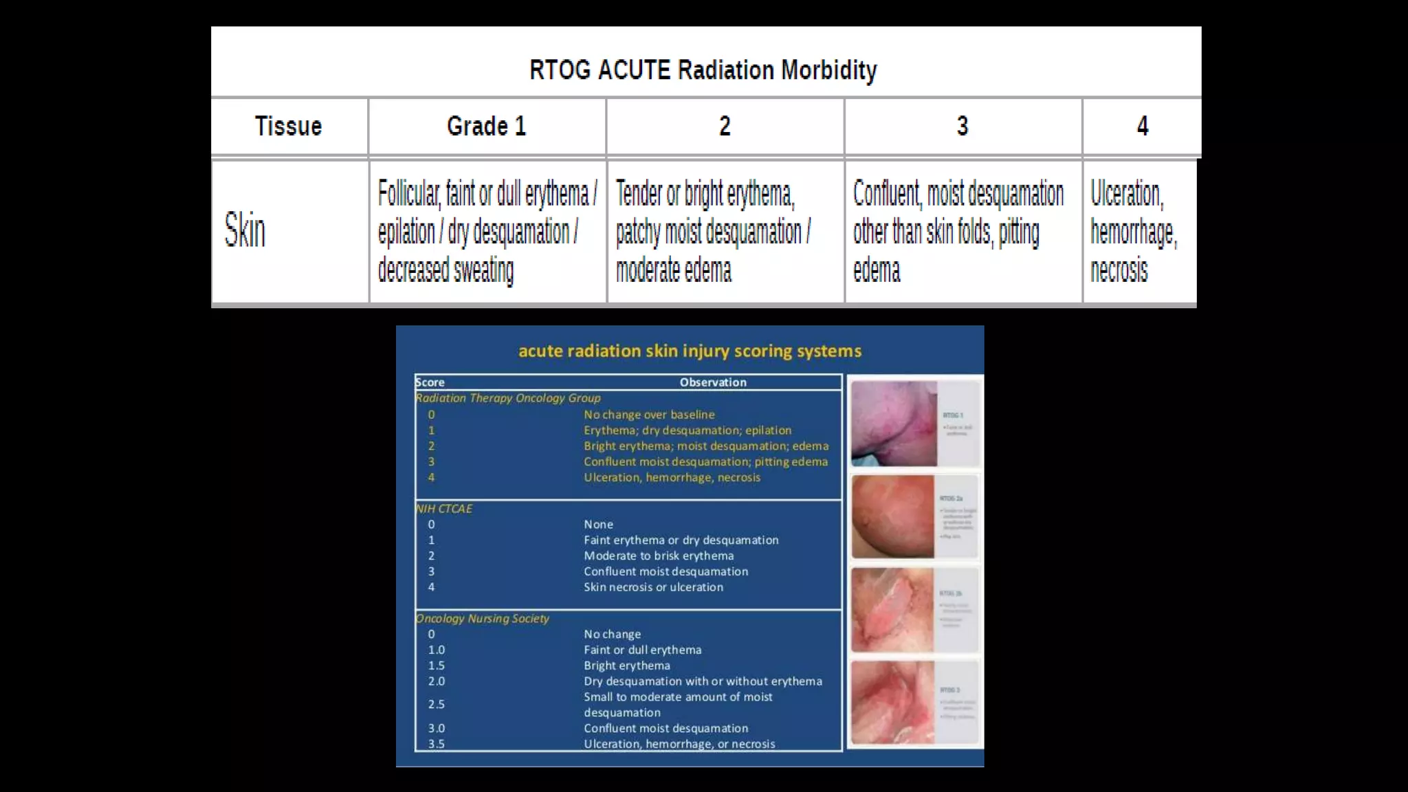 Acute and Late Radiation Related Side Effects and their Management in ...