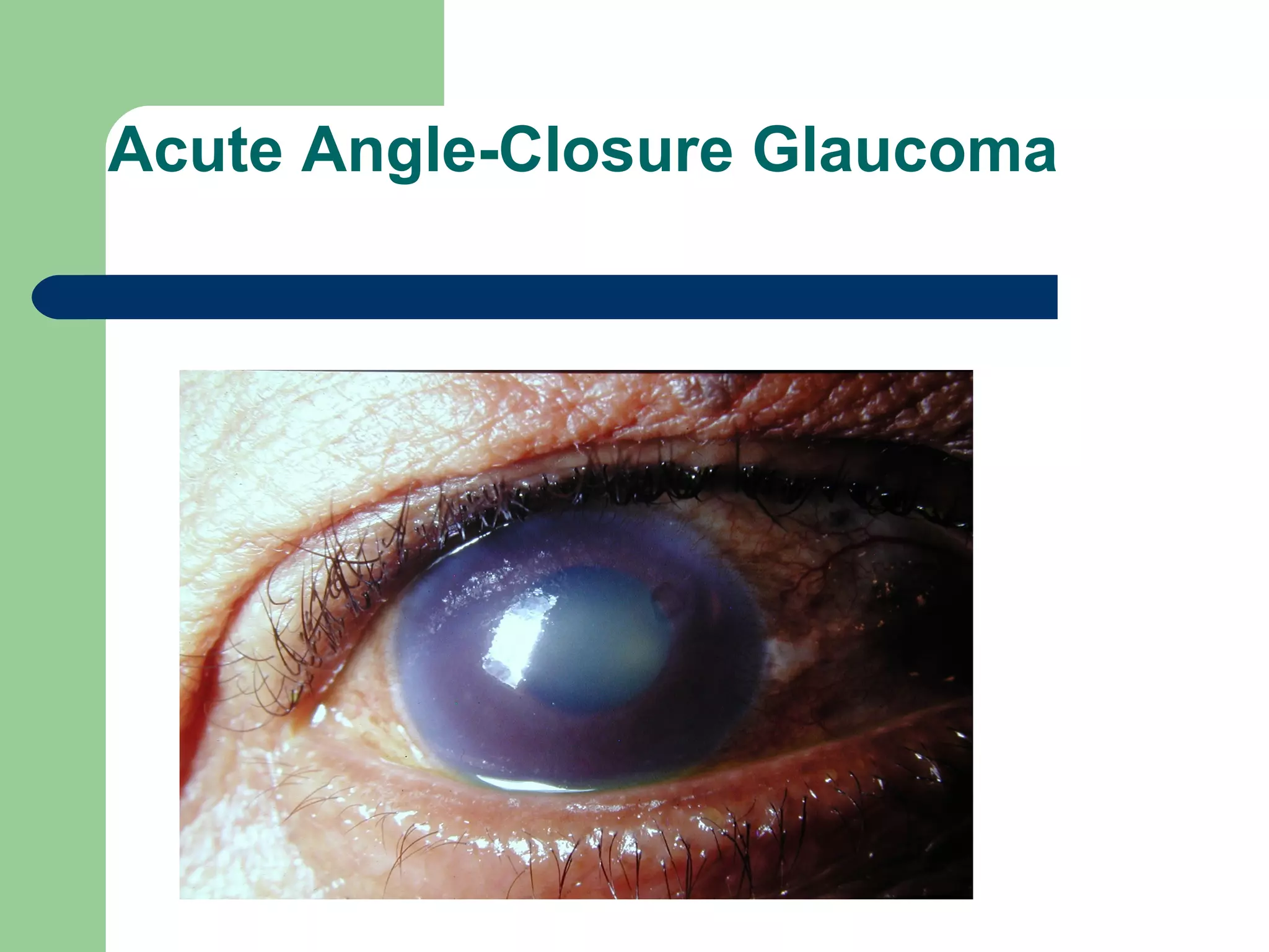 Acute Angle Closure Glaucoma | PPT