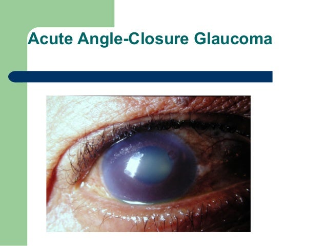 Acute Angle Closure Glaucoma Acute Angle Closure Glaucoma