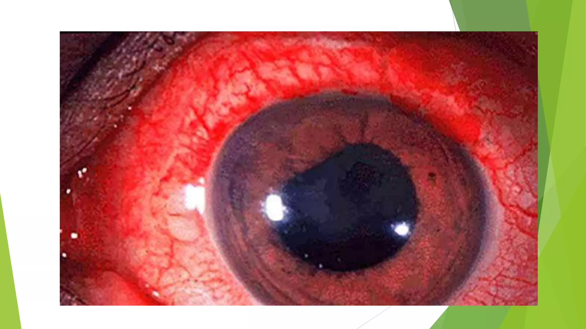 Acute anterior Uveitis.pptx
