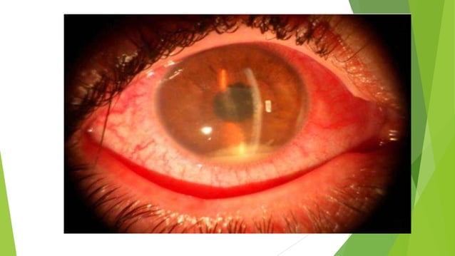 Acute anterior Uveitis.pptx | Eye and Vision Conditions | Diseases and ...