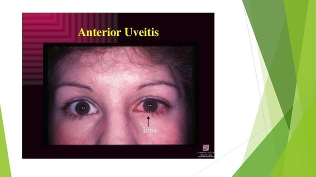 Acute anterior Uveitis.pptx | Eye and Vision Conditions | Diseases and Conditions