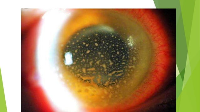 Acute anterior Uveitis.pptx | Eye and Vision Conditions | Diseases and ...