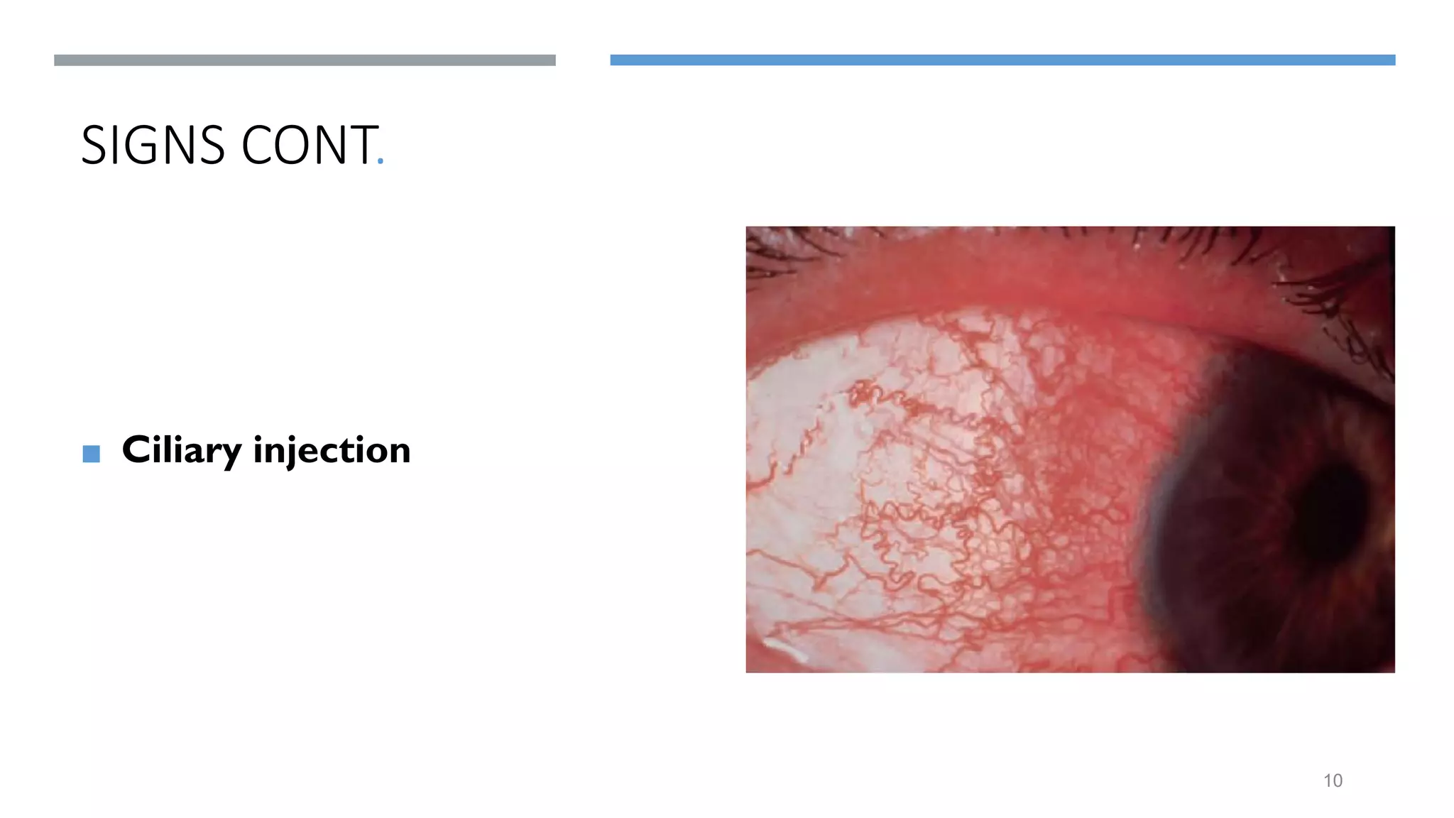 Acute anterior uveitis by Dr. Rubana.pptx