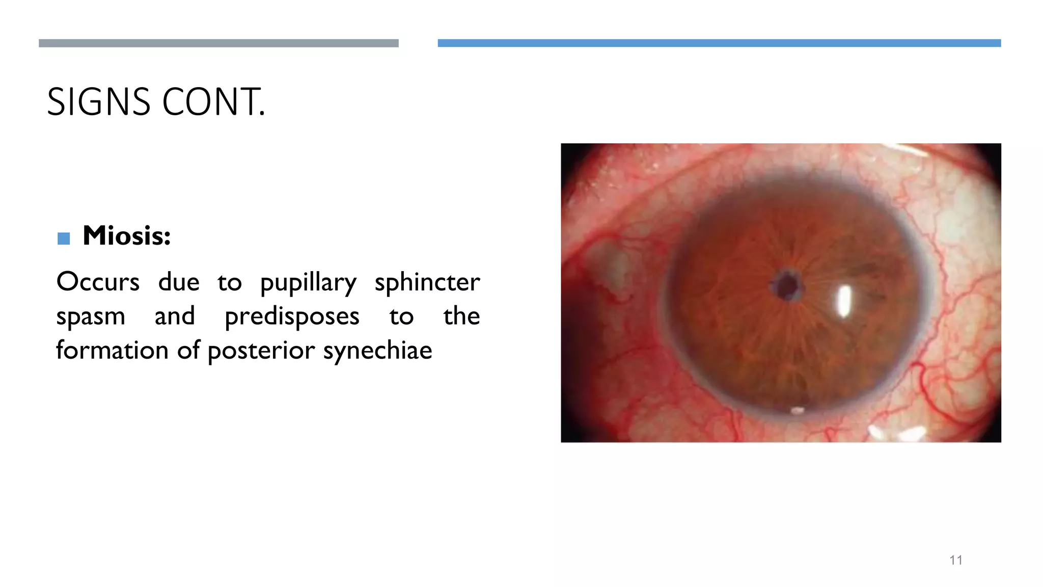 Acute anterior uveitis by Dr. Rubana.pptx