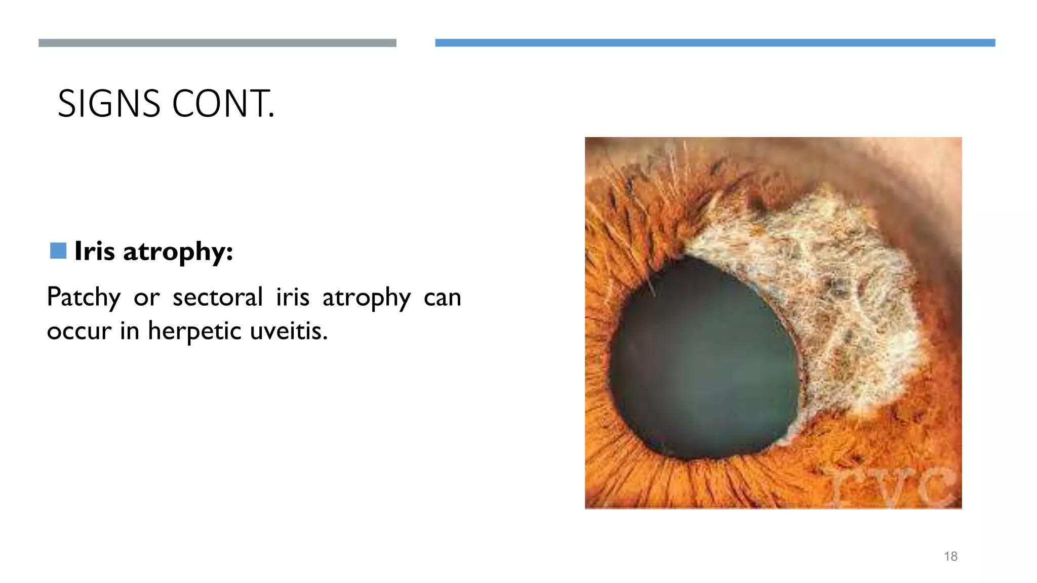 Acute anterior uveitis by Dr. Rubana.pptx