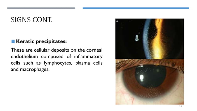 Acute anterior uveitis by Dr. Rubana.pptx