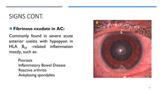 Acute anterior uveitis by Dr. Rubana.pptx