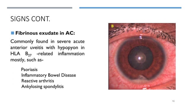 Acute anterior uveitis by Dr. Rubana.pptx