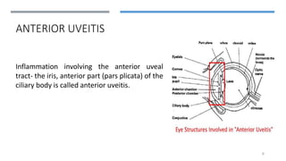 Acute anterior uveitis by Dr. Rubana.pptx