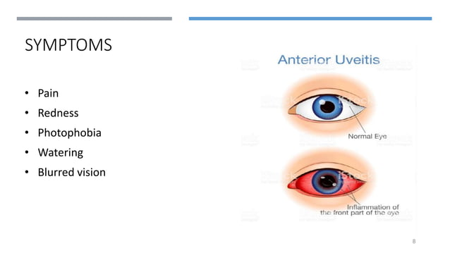 Acute anterior uveitis by Dr. Rubana.pptx