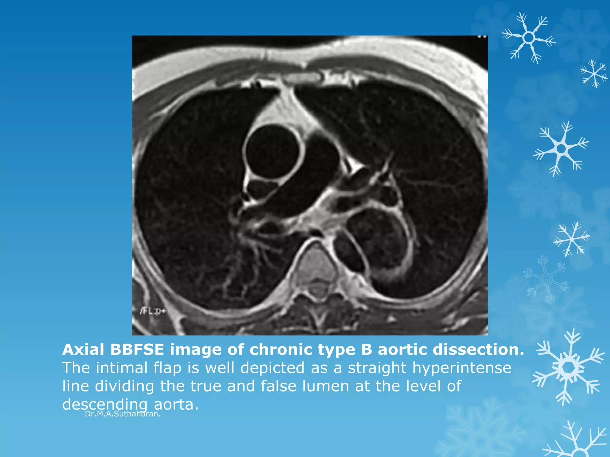 Acute Aortic Syndrome | PPTX