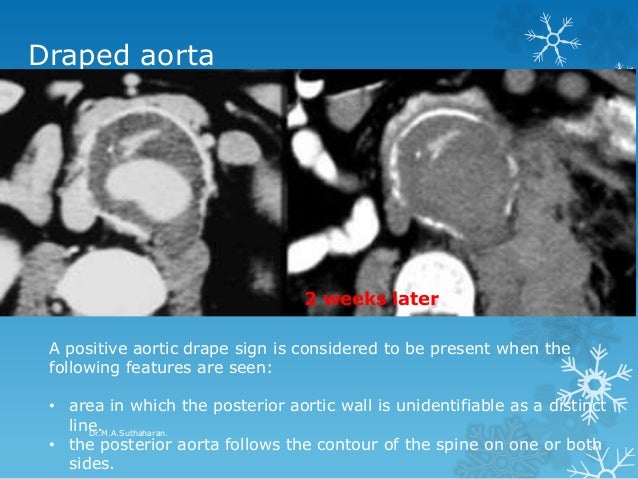 Acute Aortic Syndrome