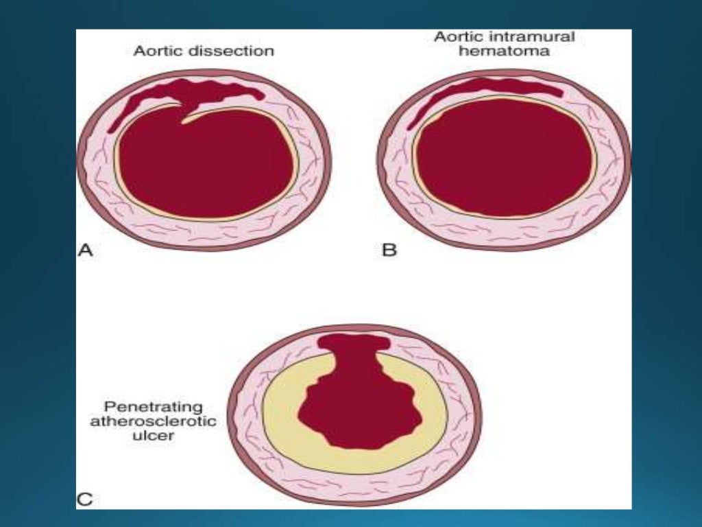 Acute aortic syndromes