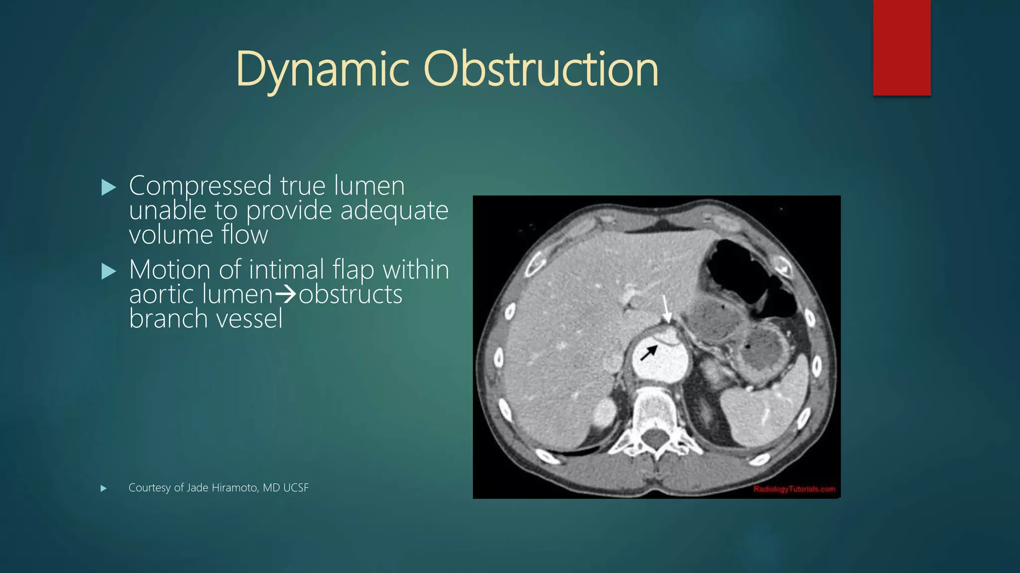 Aortic Dissection for the Vascular Surgeon | PPTX