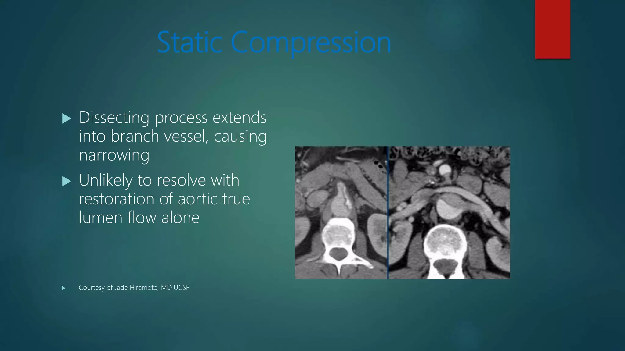 Aortic Dissection for the Vascular Surgeon | PPTX