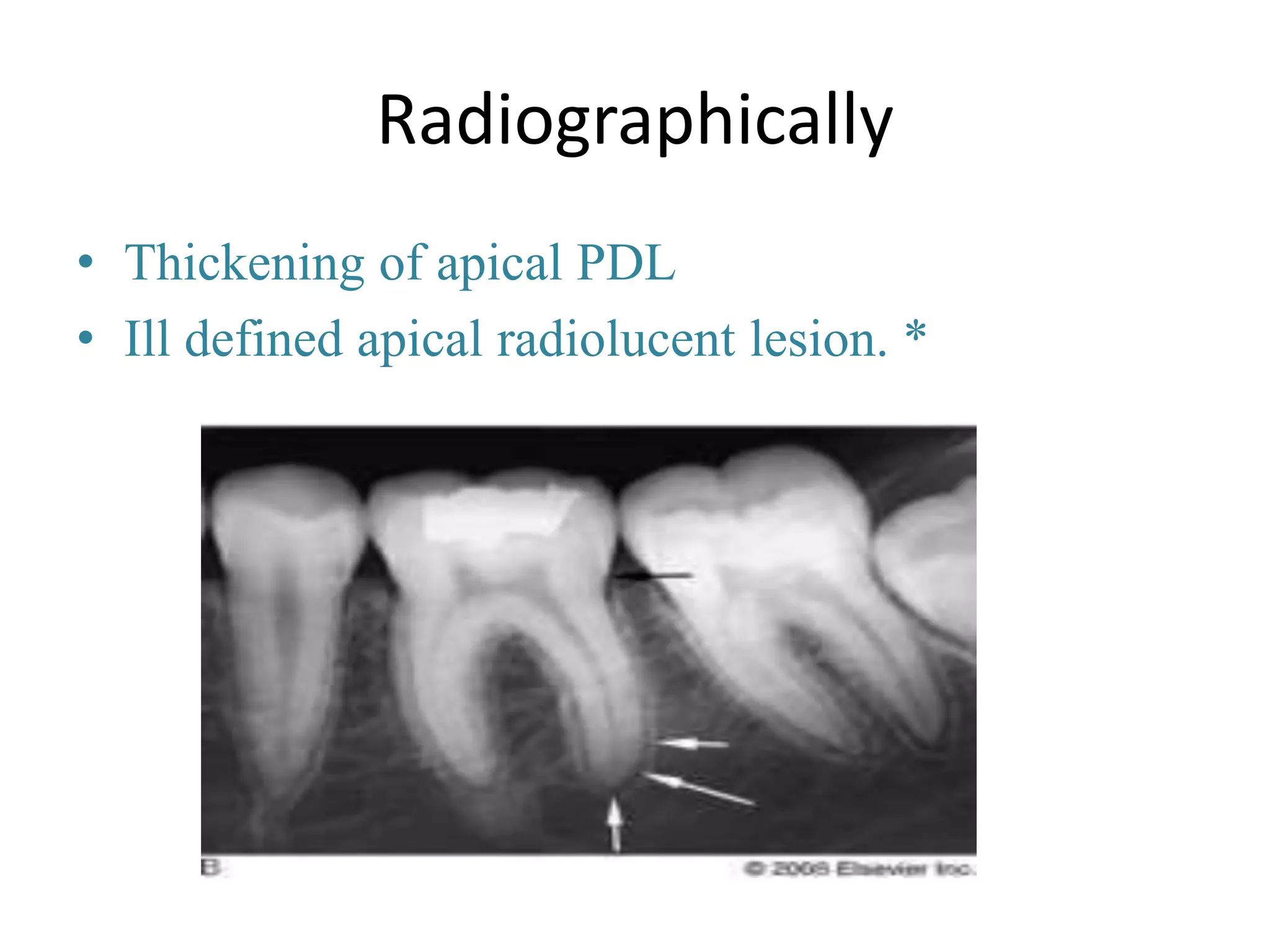 Acute apical abscess dr anirudh singh chauhan | PPTX