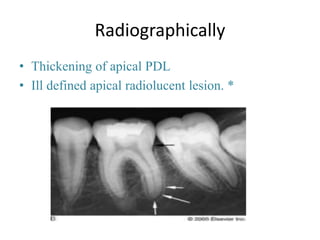 Periapical Abscess Radiograph