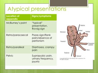 Acute appendicitis | PPTX