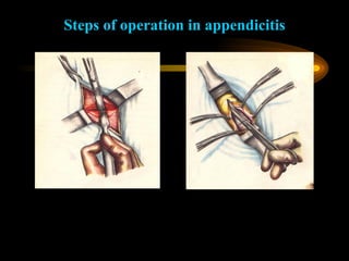 Acute appendicitis | PPT