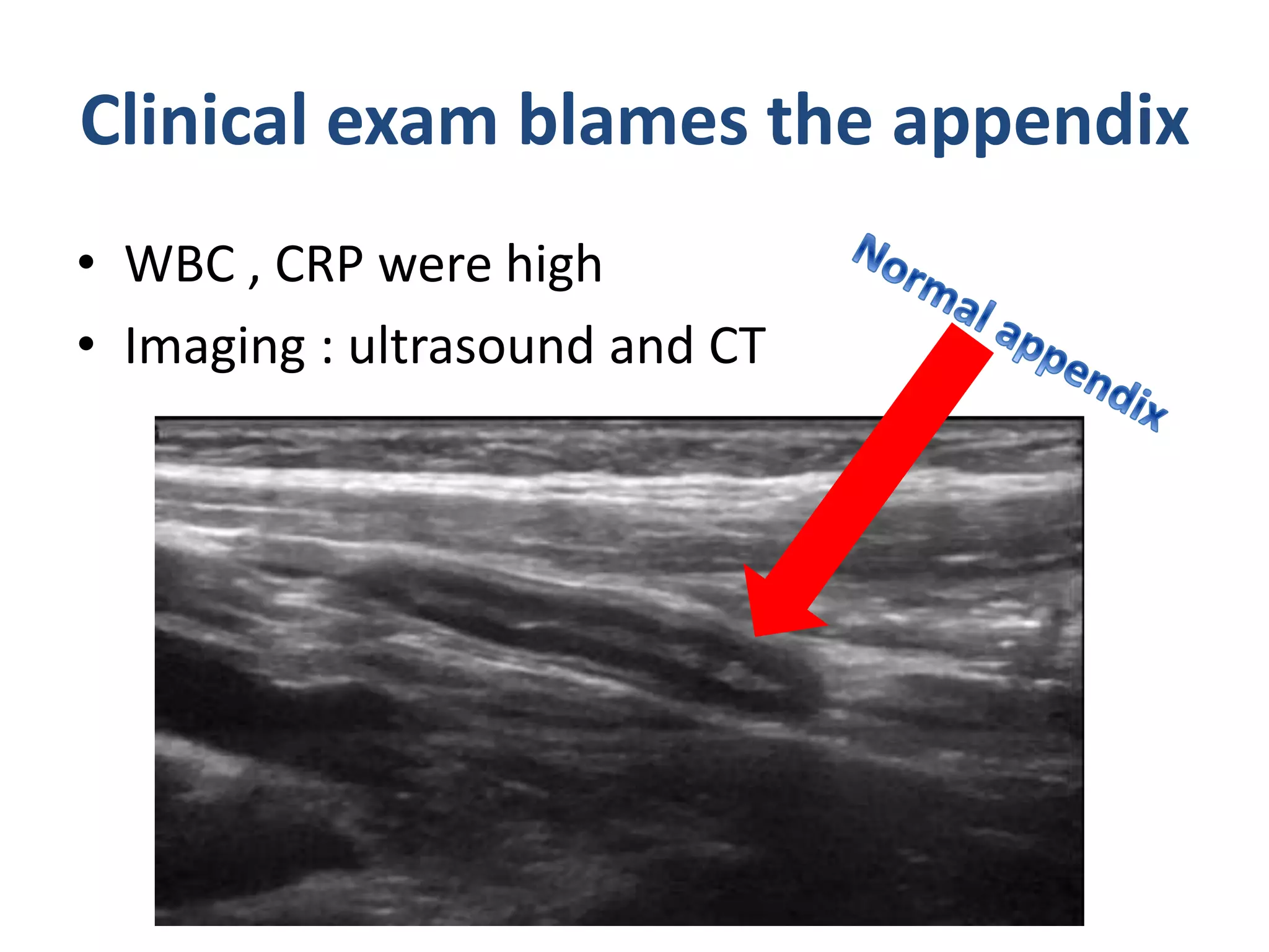 Acute appendicitis | PPTX