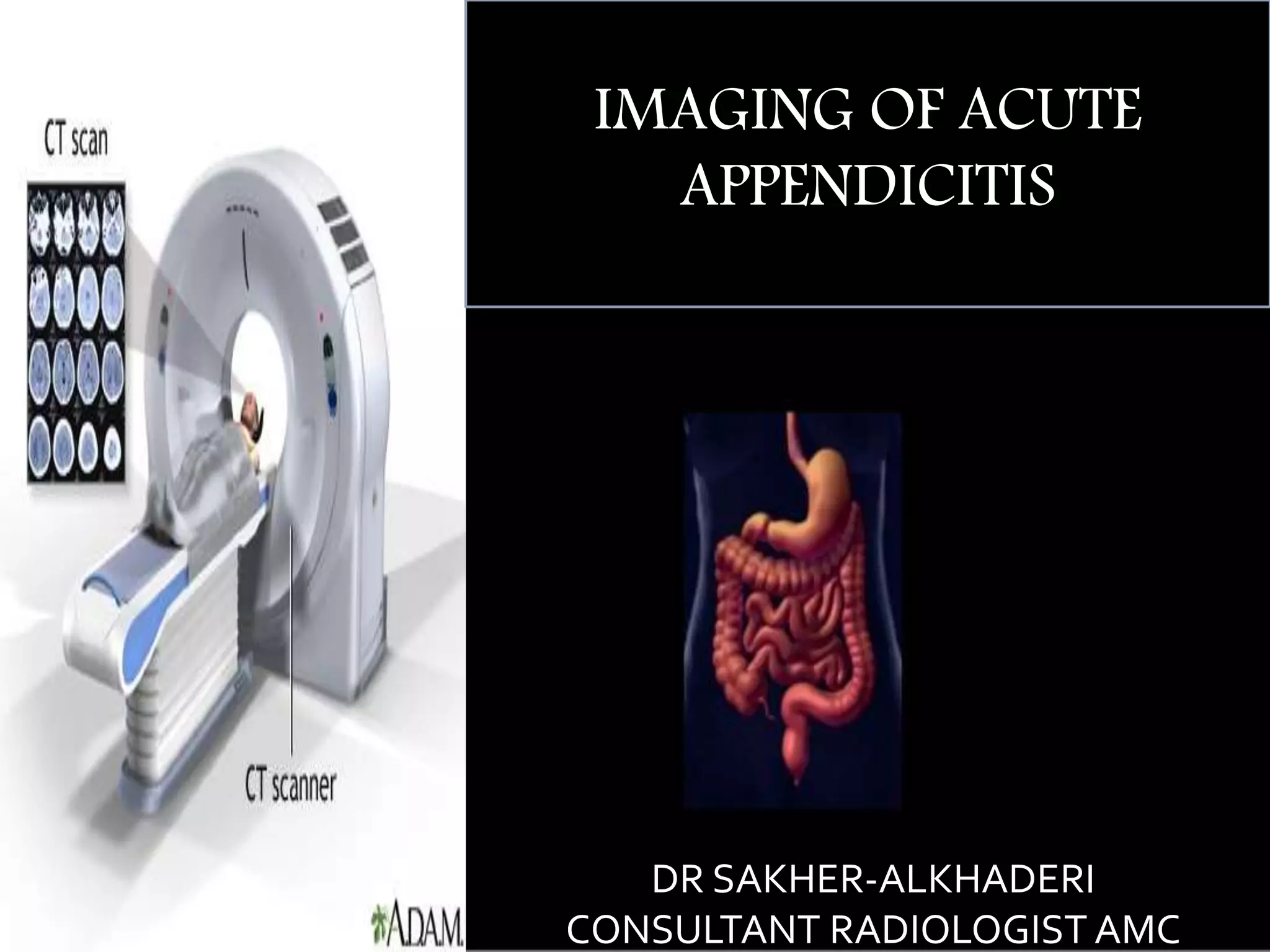 Imaging of Acute Appendicitis | PPTX