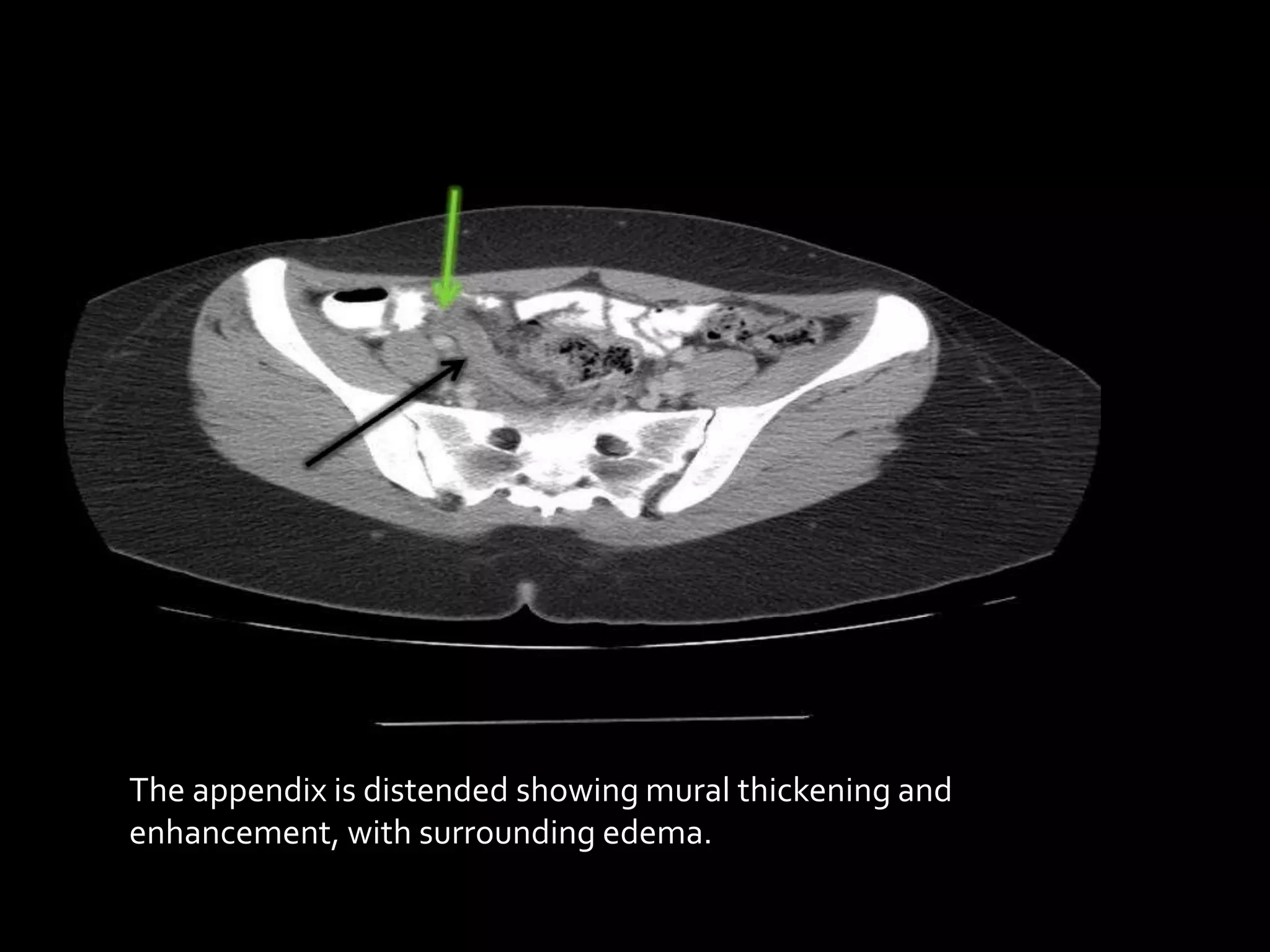 Imaging of Acute Appendicitis | PPTX