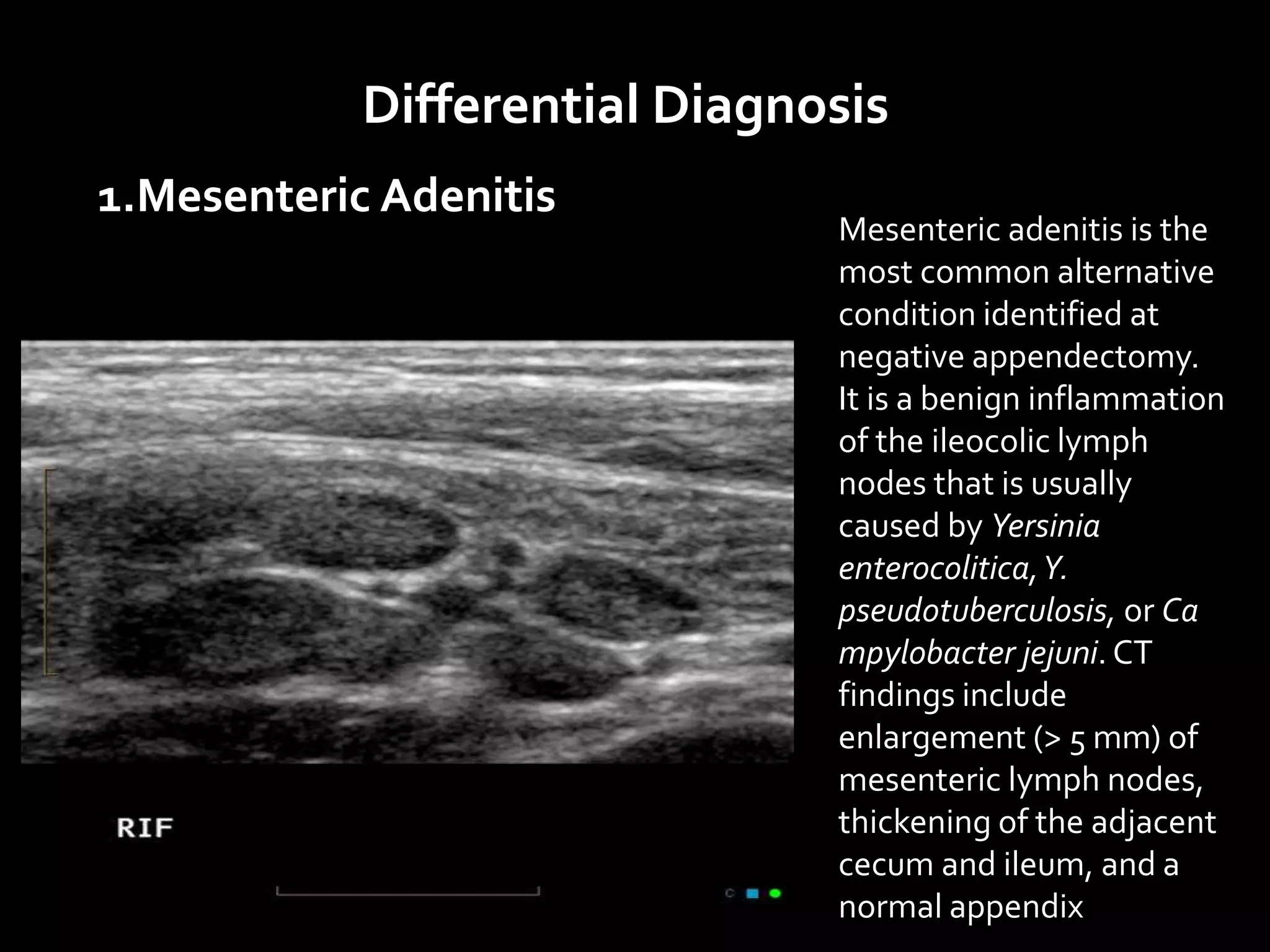Imaging of Acute Appendicitis | PPTX